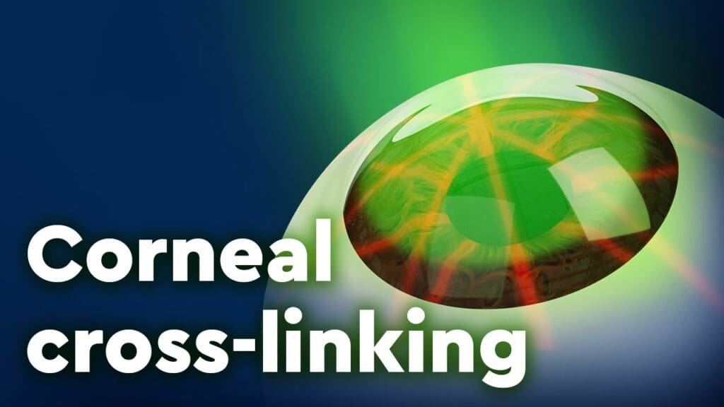 Corneal Collagen Cross Linking - Laser Pro Eye