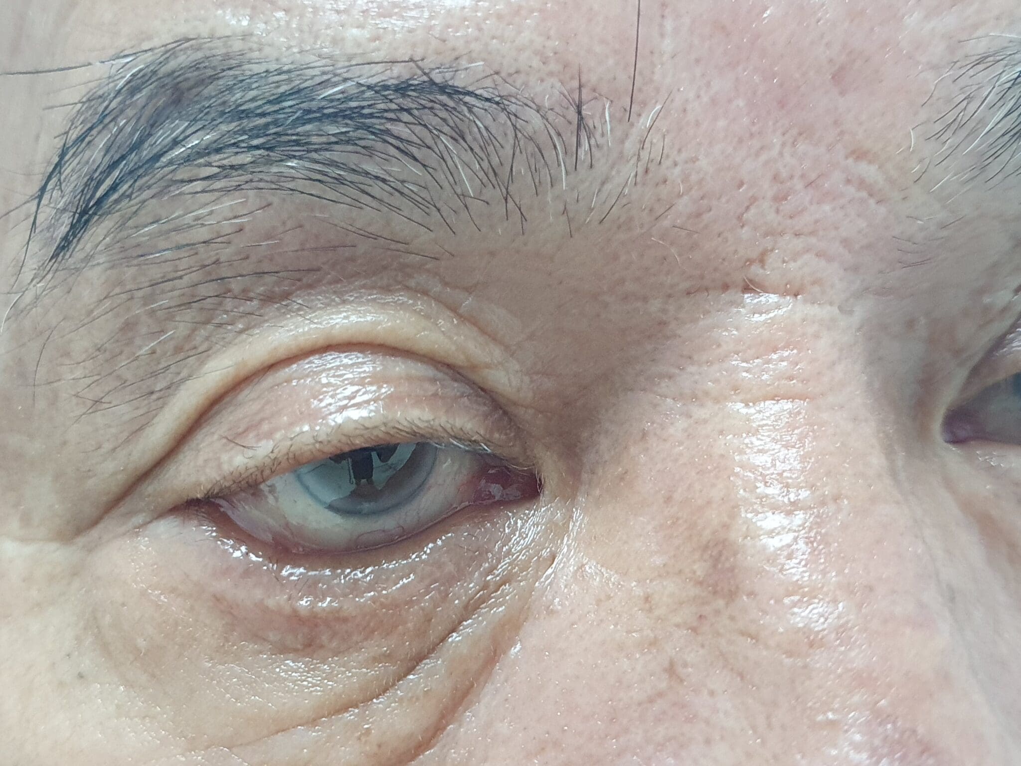 Entropion & Ectropion - Laser Pro Eye