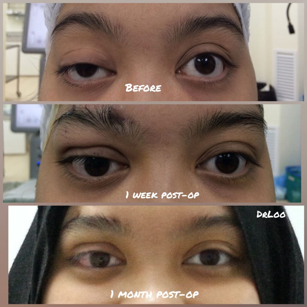 Droopy Eyelids - Laser Pro Eye