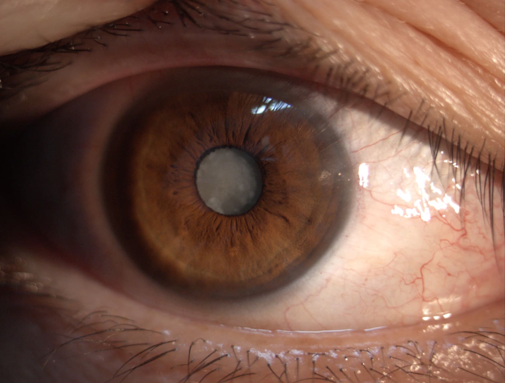 Cataracts - Laser Pro Eye