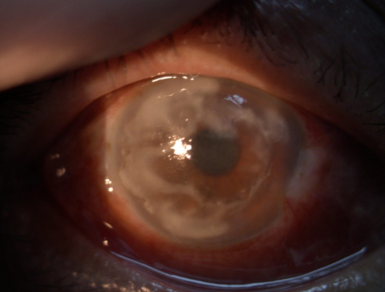 Corneal Infections - Laser Pro Eye